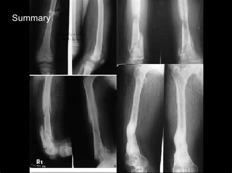 Diaphyseal Sequestrum