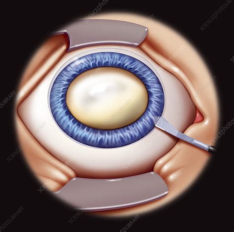 Cataract Surgery Drawing Stock Image C0040853 Science Photo Library