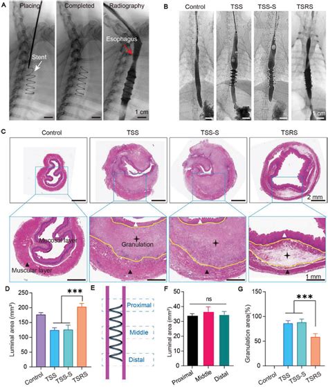Inhibition Of Tsrs On In‐stent Stenosis Edge Stenosis And Granulation