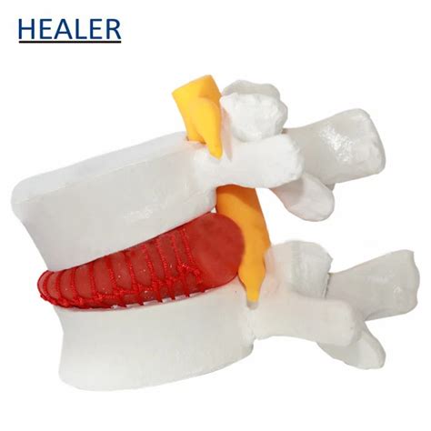 Human Lumbar Intervertebral Disc Modelteaching Demonstration Model