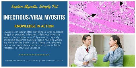 Infectiousviral Myositis Myositis Support And Understanding
