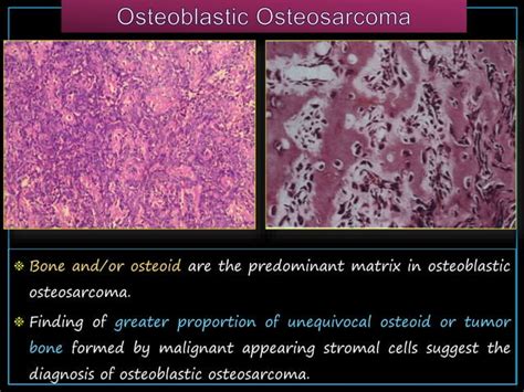 Osteosarcomappt Bone And Joint Conditions Diseases And Conditions