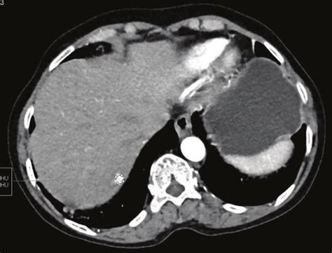 Hypervascular Liver Metastasis Such As Above Case Is Typical Of