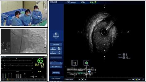 Pci And Rotational Atherectomy Of Severe Calcified Lad Under The Guidance Of Ivus Youtube