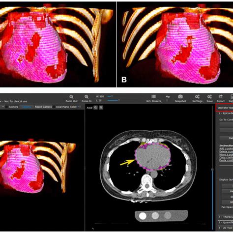 Deep Learning Based Quantification Of Epicardial Adipose Tissue Download Scientific Diagram