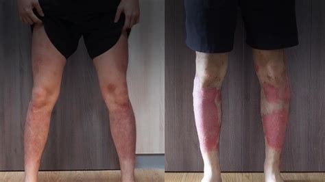 Genitals And Psoriasis How Do You Prevent From Peeling During Sex😭the