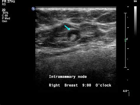 Atlas Of Breast Cancer Early Detection