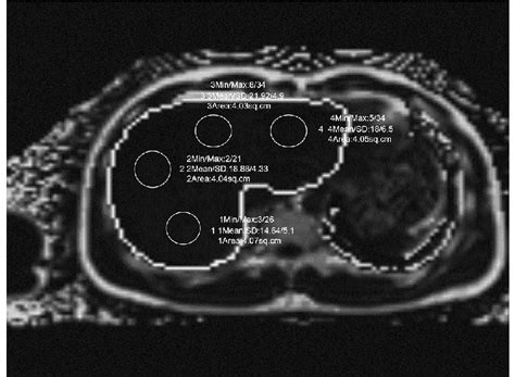 Schematic Diagram For Measurement Of The Liver Fat Content In Mri Pdff
