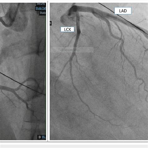 Coronary Angiogram Which Shows Non Obstructive Coronary Arteries Lad