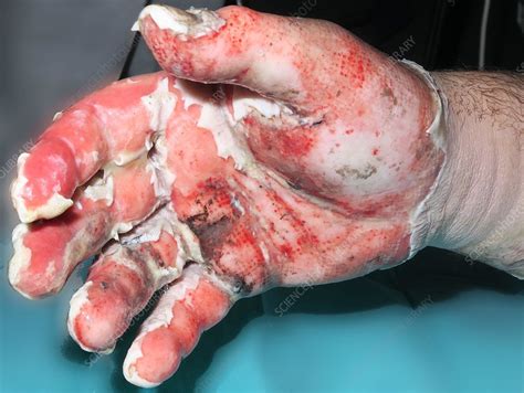 Second Degree Burn Stock Image C0602516 Science Photo Library