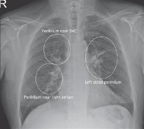 Linear Atelectasis Around The Hilum On Chest Radiography A Novel Sign Of Early Lung Cancer Pmc
