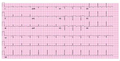 A 12 Lead Ecg Showing The Qt Interval Prolongation Up To 600 Msec On