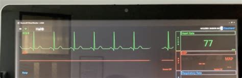 Dysrhythmia Practice Flashcards Quizlet