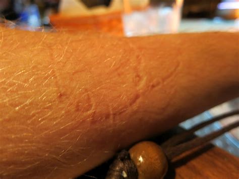 The Not So Extraordinary Life Of Jonas In Sapporo Bite Marks
