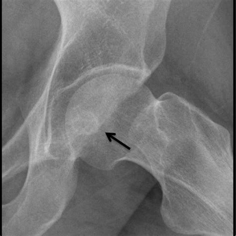 Pdf Osteoid Osteoma Of The Femoral Head Treated By Radiofrequency