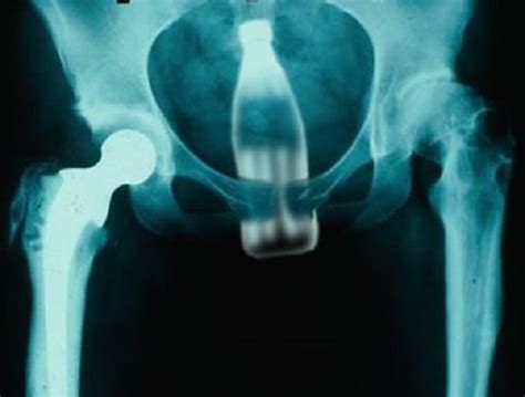 Ten Crazy And Strange Things Found Inside Peoples Bodies