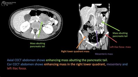 17 Year Old Female Presented With Suspected Dental Hematoma Or Abscess American Society Of