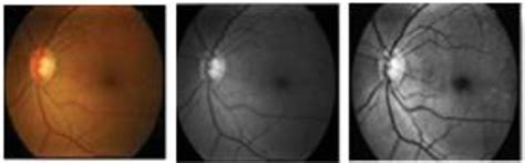 Figure 1 From Sparse Auto Encoder Based Micro Aneurysm Detection