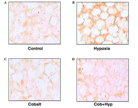 Immunohistochemical Staining With Vegf Antibody B Abundant Staining