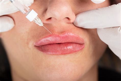 Lip Filler Swelling Stages The Day By Day Rundown