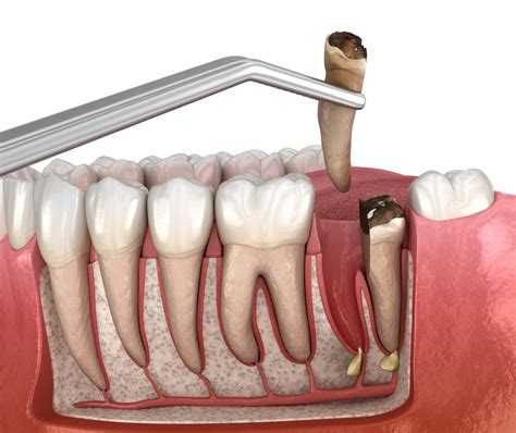 جراحی در نسج سخت چیست؟ کلینیک دندانپزشکی شبانه روزی زاگرس