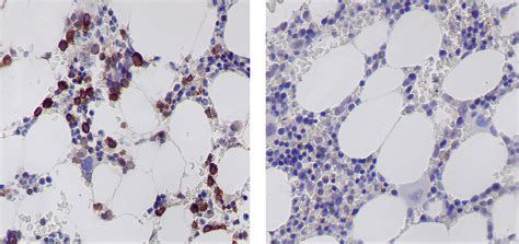 Pathology Outlines Kappa Lambda Light Chains