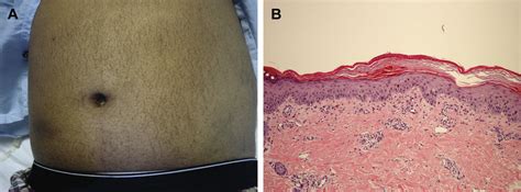 A Drug Reaction Linear And Reticulated Areas Of Hyperpigmentation On