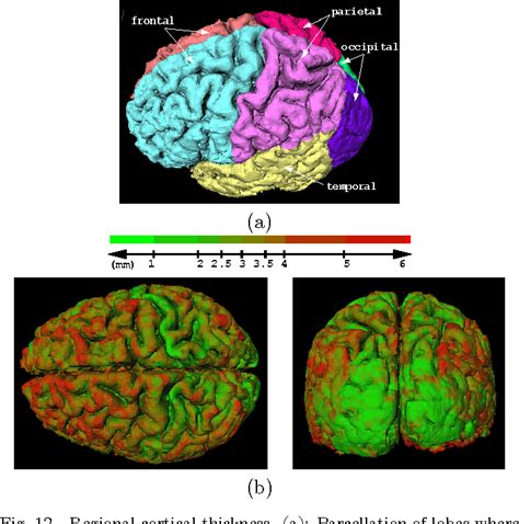 figure 1 from segmentation and measurement of the cortex from 3 d mr
