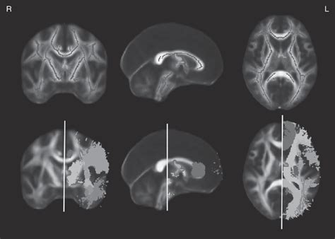 map of the mean diffusivity md differences between groups patients