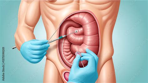 Ilustración De Stock Colonoscopy Intestine Polypectomy Procedure