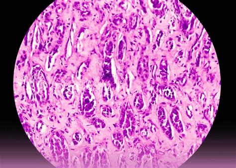 Open Radical Nephrectomy For Large Renal Tumors