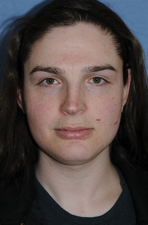 Transgender Surgery Before And After Photos Seattle Bellevue