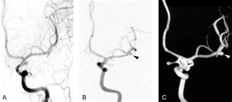 New Detected Aneurysms On Follow Up Screening In Patients With