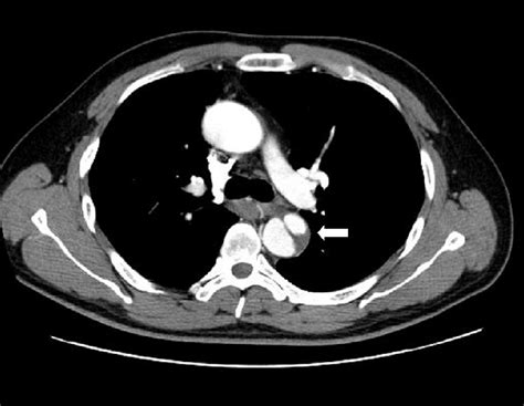 Computed Tomography Revealed Debakey Type 3 Aortic Dissection White