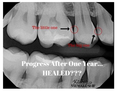 Reversing Cavities Is Truly Possible Teeth Can Heal