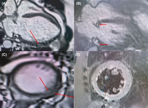 Cardiac Sarcoidosis Two Case Reports Pmc