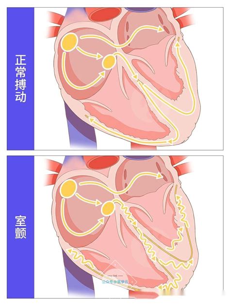 【心脏急救】心脏骤停和心脏颤动 知乎