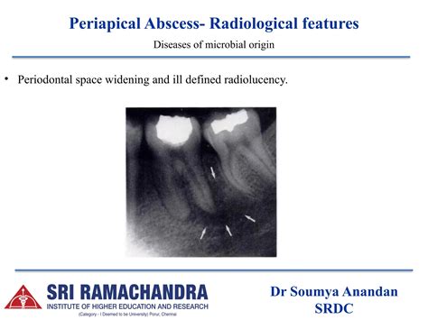 Apical Peridontal Cyst Periapical Abscess Pptx