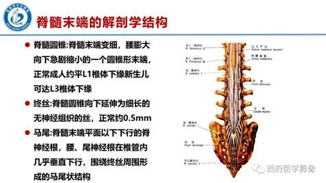 PPT脊髓栓系综合征的影像表现与鉴别诊断 影像PPT