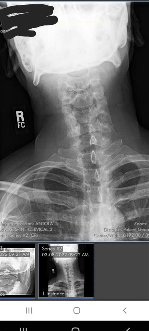 3 Weeks Into Healing A Scaphoid Fracture X Ray Any Thoughts On Healing Time For This Location