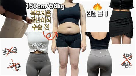 지방흡입6 복부지흡 골반이식 두달 차 후기 복부지방흡입 지방흡입 골반이식 Youtube