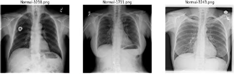 Figure 1 From Tuberculosis Detection In Chest X Rays Using Hybrid Deep Learning Models