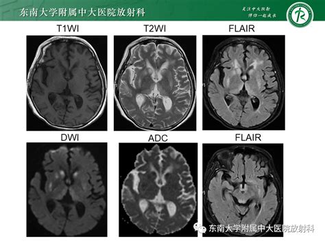 双侧基底节区病变的影像分析思路 医学界 助力医生临床决策和职业成长