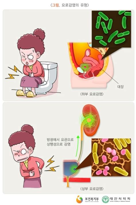 급성 신우신염 네이버 블로그