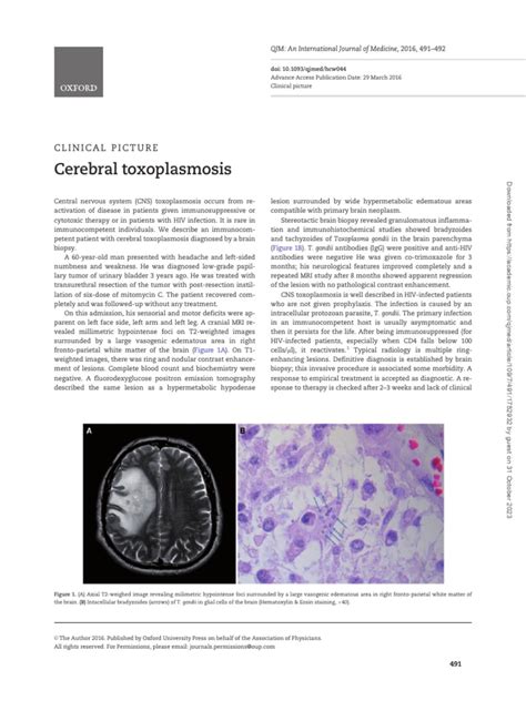 Cerebral Toxoplasmosis 1 Pdf Clinical Medicine Medical Specialties