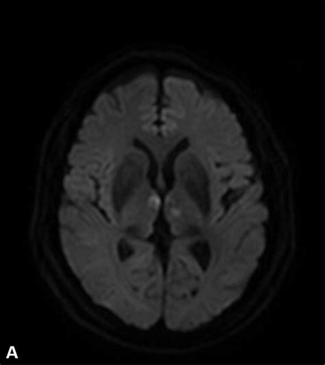 Examples Of Image Quality Evaluation Of Clinical Dwi From Stroke
