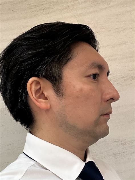 肌質改善目的のヒアルロン酸 ボライト注入翌日右頬部のみ ダウンタイムはこんな感じ セルフ打ち 効果を見るために右側のみのハーフサイドテスト