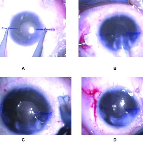 A Scleral Fixation Using Yamane Technique B Securing The Haptics Download Scientific