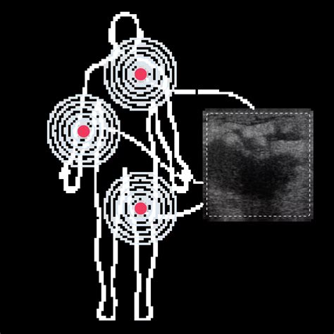 Soft Tissue Lumps And Bumps Ultrasound Scan
