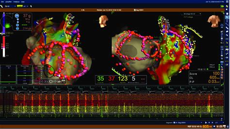 Right Atrial Mapping And Ablation Voltage Mapping Of The Right Atrium